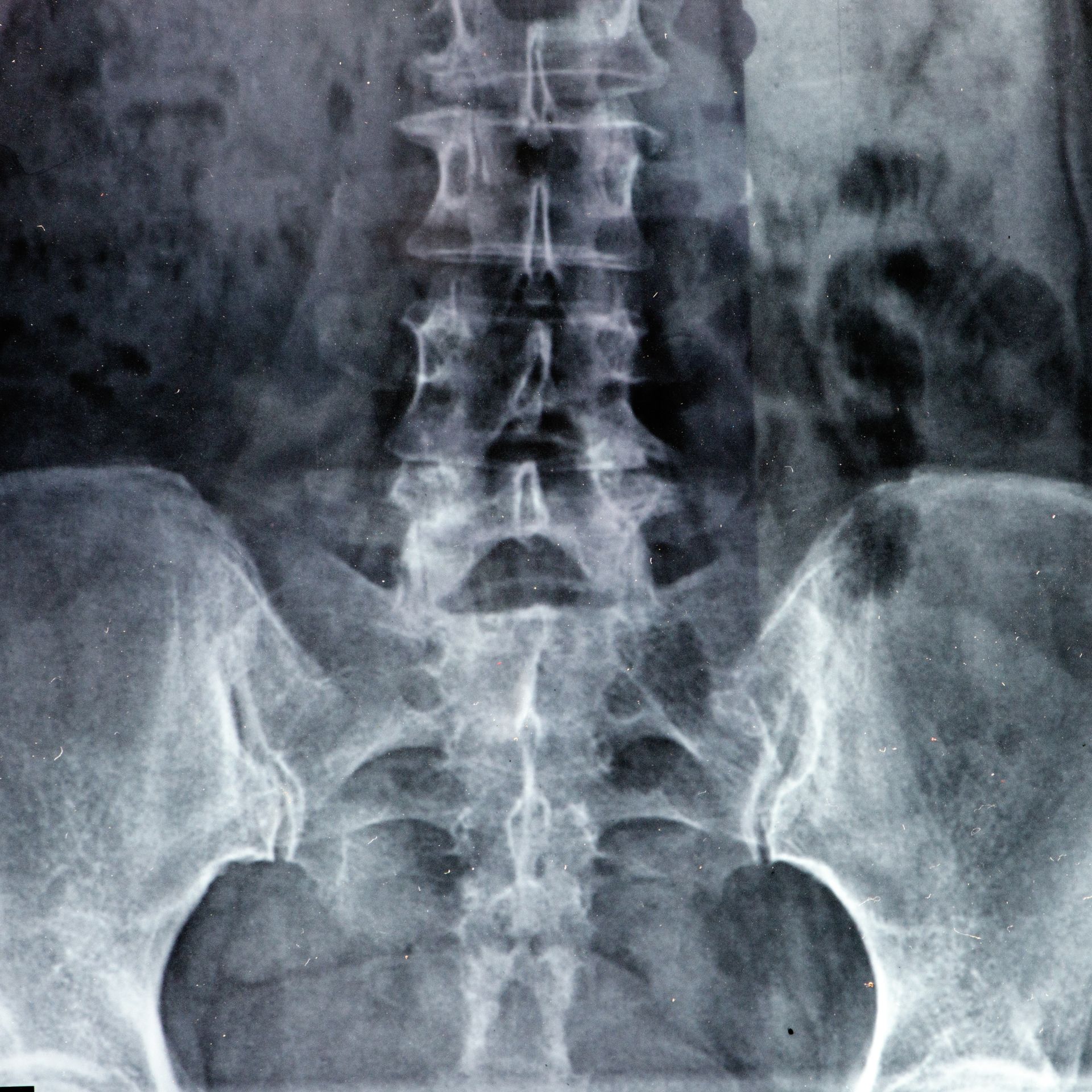 What To Do If You Get A Herniated Disc From A Car Accident | Harper ...